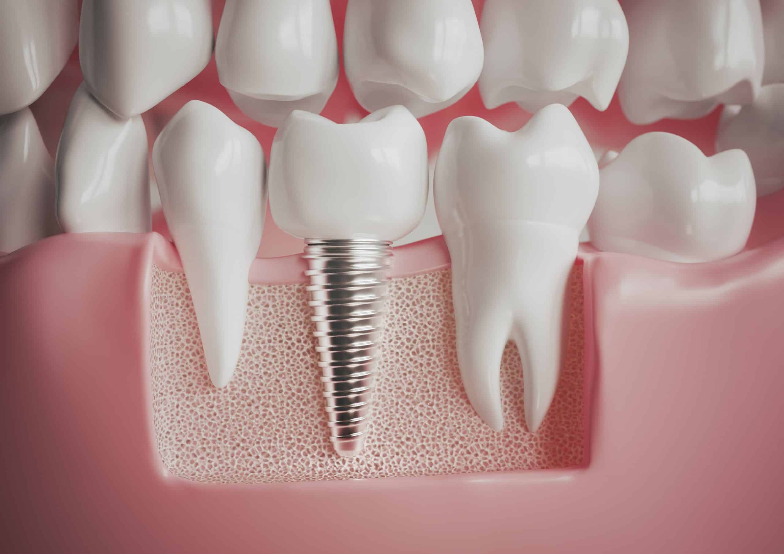 Dental Implants Preston, Melbourne - Affordable Implants Plans